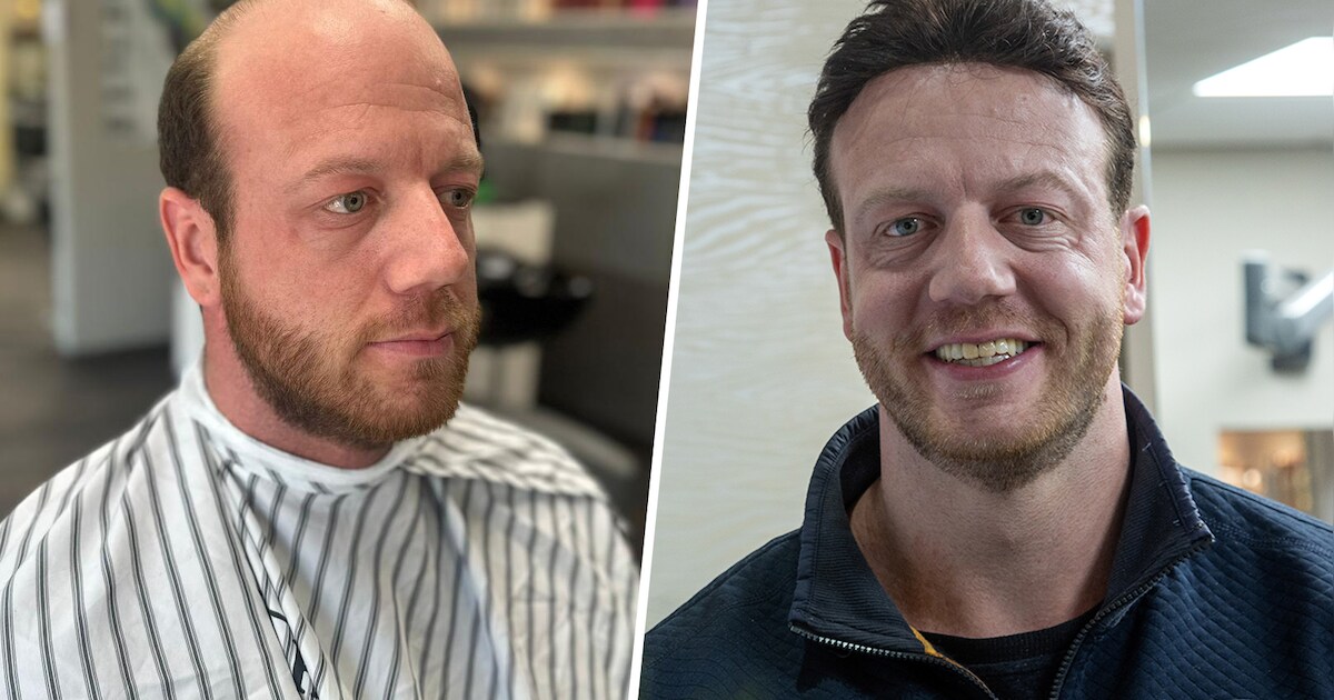 Nick (30) worstelt jaren met kaalheid, maar heeft door een ‘foefje’ van ...
