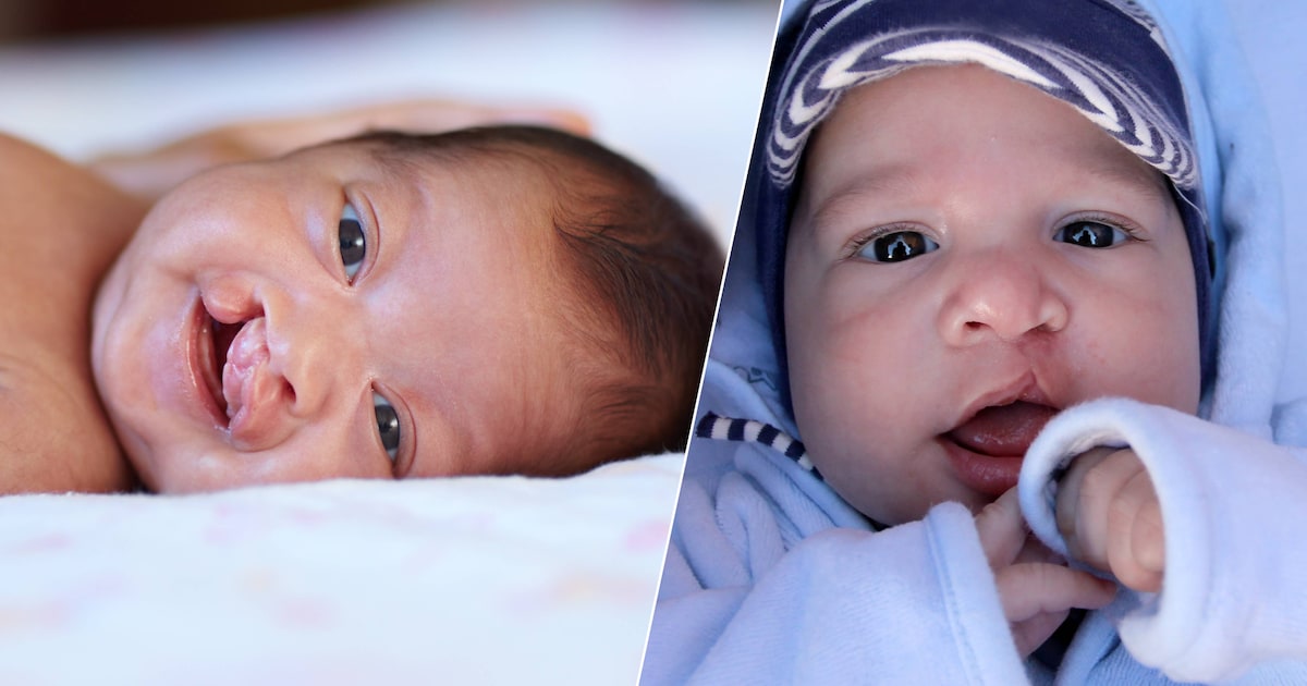 300 baby’s per jaar worden geboren met schisis: ‘Sommige patiënten ...