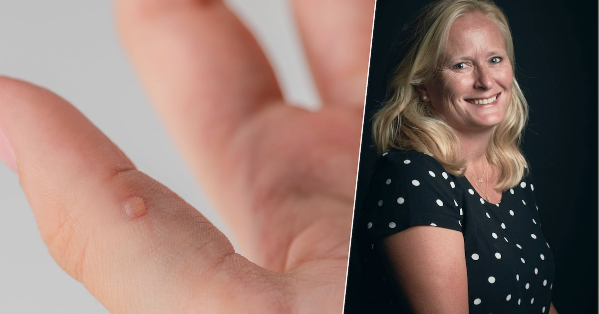 Gewone wrat, waterwrat en genitale wrat: zo ontstaan ze en dit kun je ...